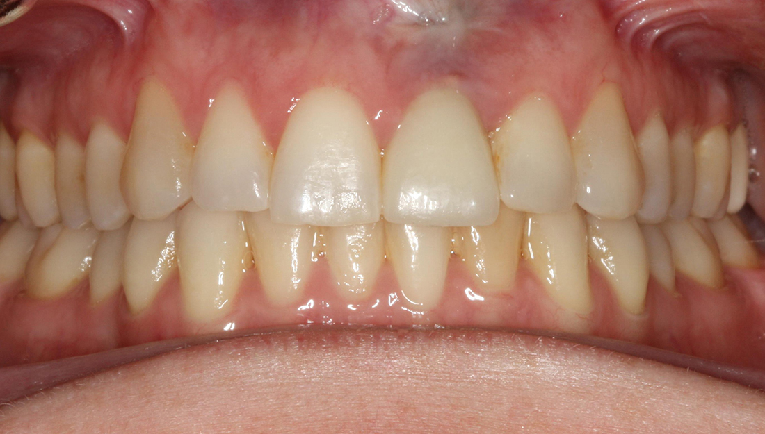 Modern Dental Lab USA - ShadeWave