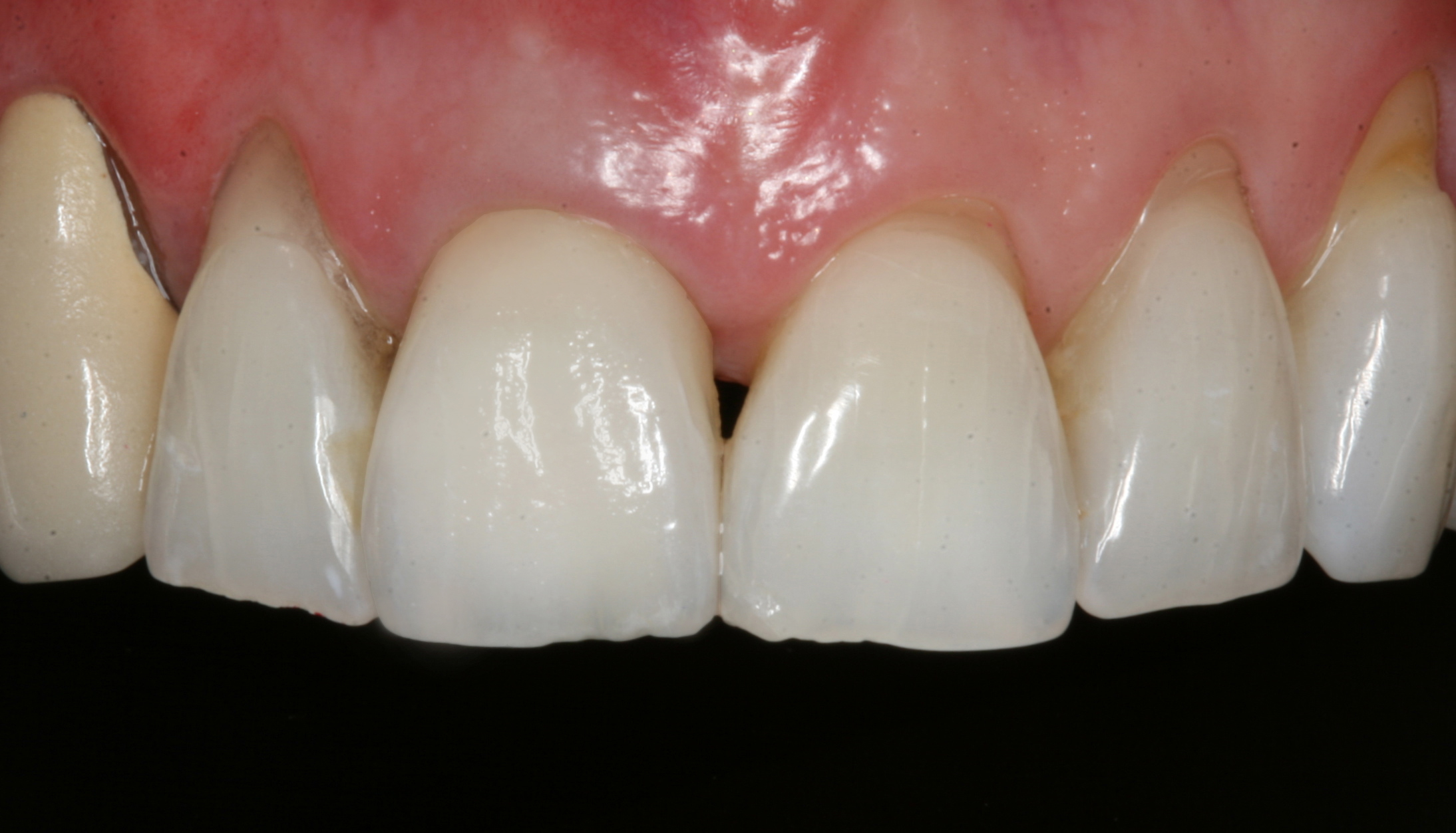 Microdental Lab - ShadeWave