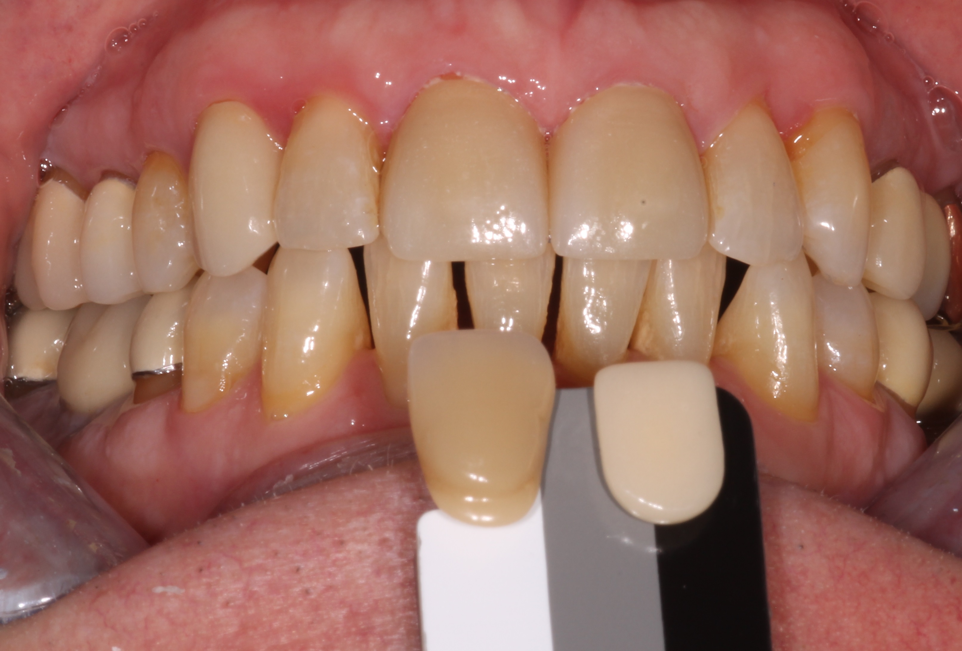 Microdental Laboratories - ShadeWave